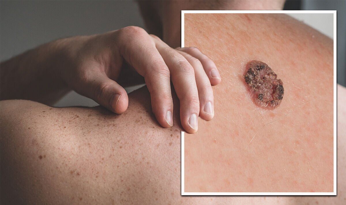 Skin Cancer Cases Rising in India Amid Increased Sun Exposure and ...